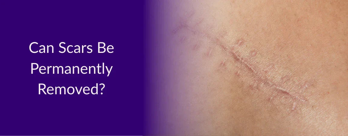 Permanent Scar Removal - Top Treatments & Scar Removal Methods – BIOCORNEUM